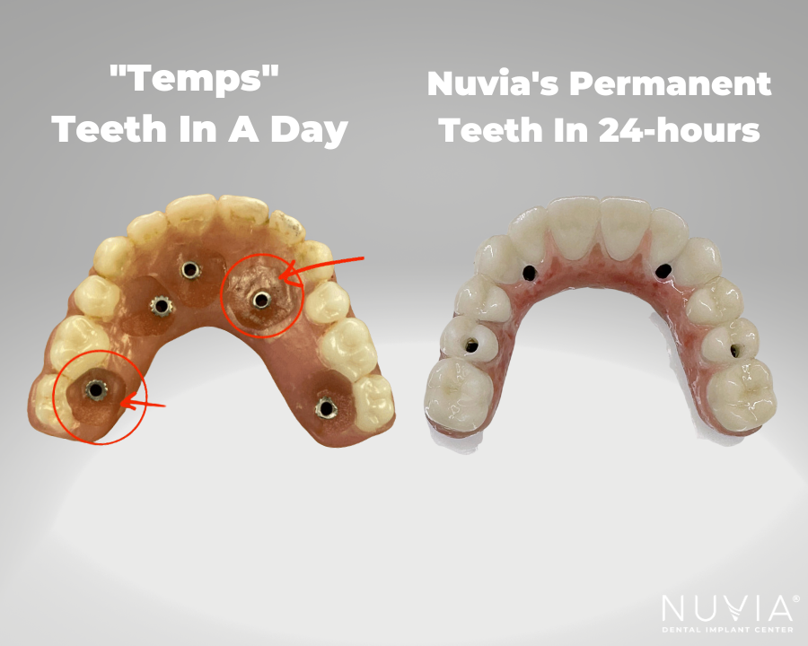 Nuvia's Permanent Teeth in 24 Hours VS Teeth-In-A-Day.